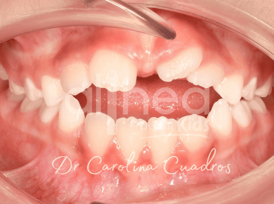 Chupón en Niños: Beneficios y Precauciones para una Sonrisa Radiante ...